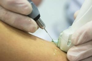 Dry Needling For Tendonitis Pain Relief - Does It Work? | Primal ...